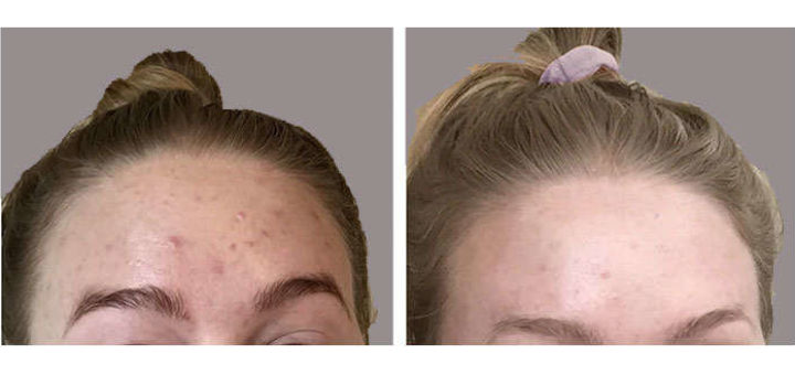 Zudenina plus gel forte para acné, modo de uso y aplicación