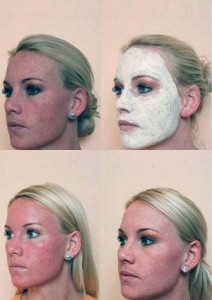 Peeling fenol y precio de exfoliación facial química